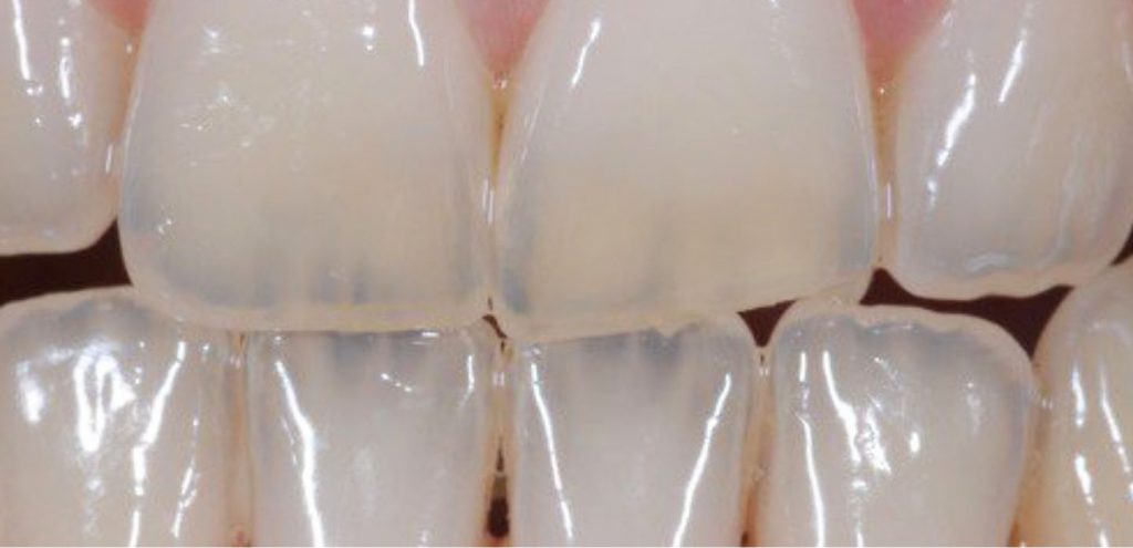 IRAZABAL CLINICA DENTAL | Transparencias en los dientes, causas y ...